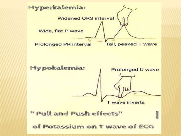 Approach to management of Hyperkalemia | PPTX | Endocrine and Metabolic ...