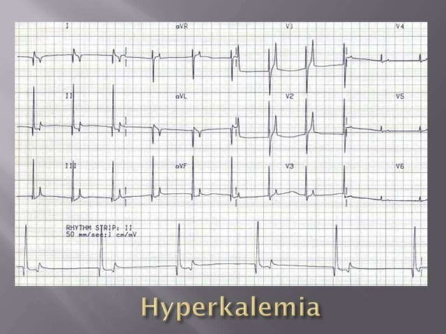 Hyperkalemia and its management | PPTX