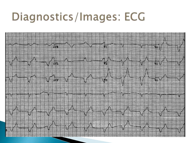 Hyperkalemia and its management | PPTX