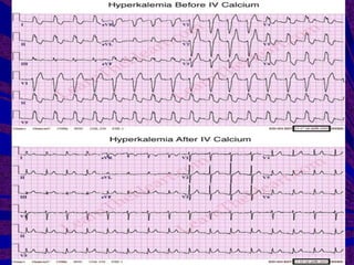 Hyperkalemia in children | PPT