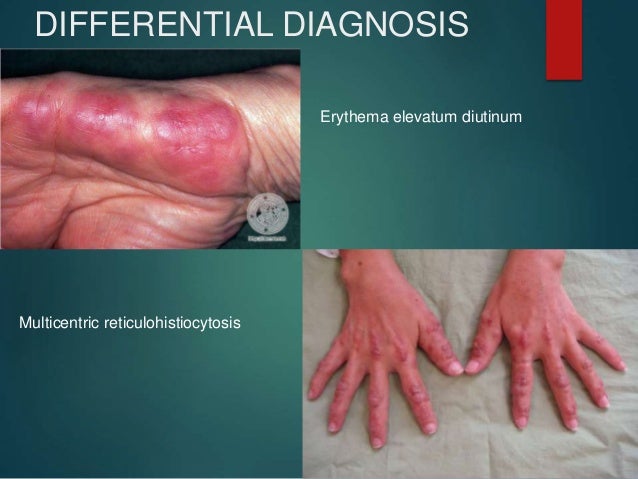 Xanthomas Plane Planar Xanthoma Palmar Xanthoma