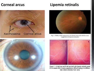 Lipemia Retinalis