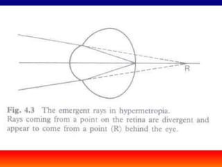 Hypermetropia | PPT
