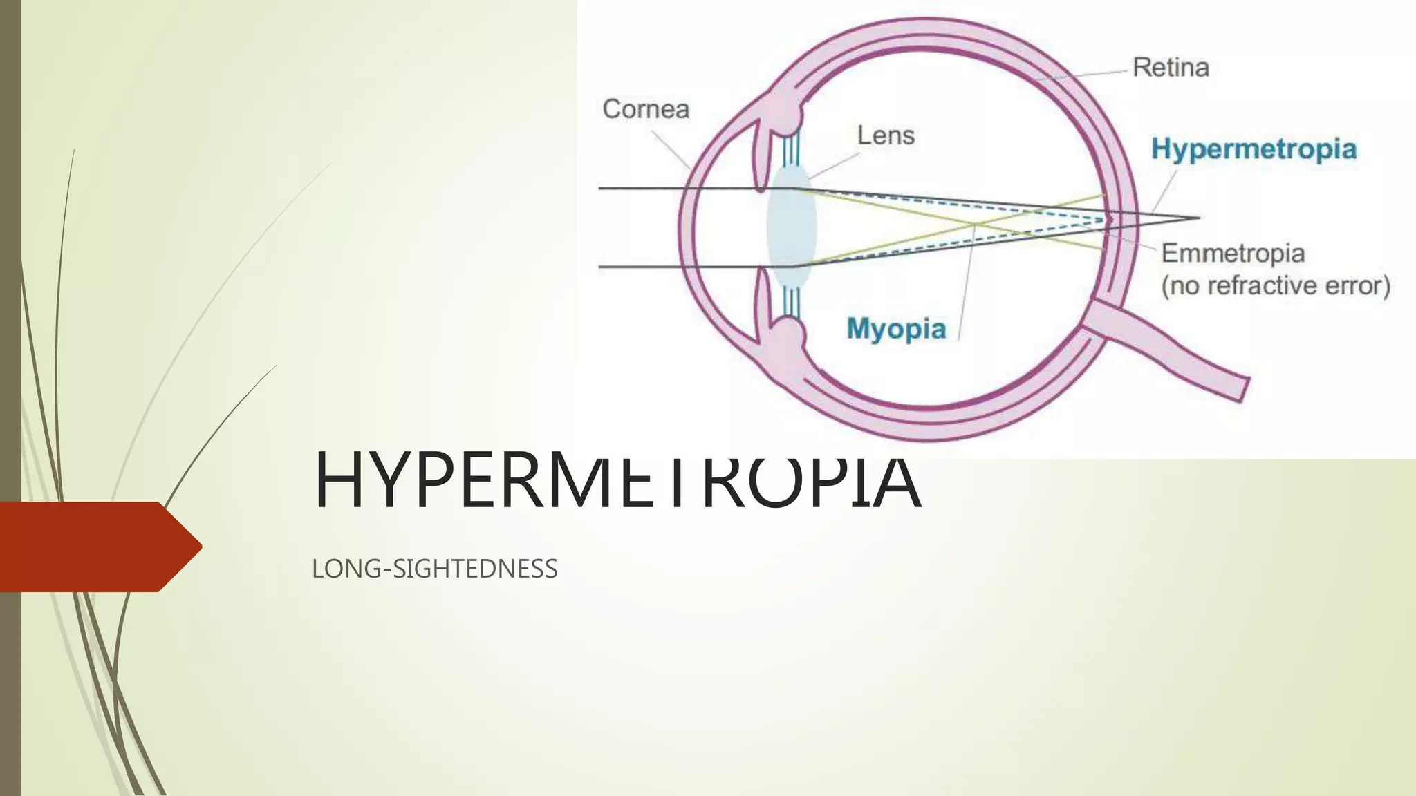 Hypermetropia | PPTX