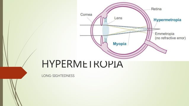 Hypermetropia | PPT