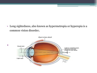 Hypermetropia | PPTX