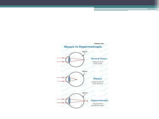 Hypermetropia | PPT