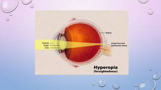 hypermetropia: a refractive error | PPTX | Eye and Vision Conditions ...