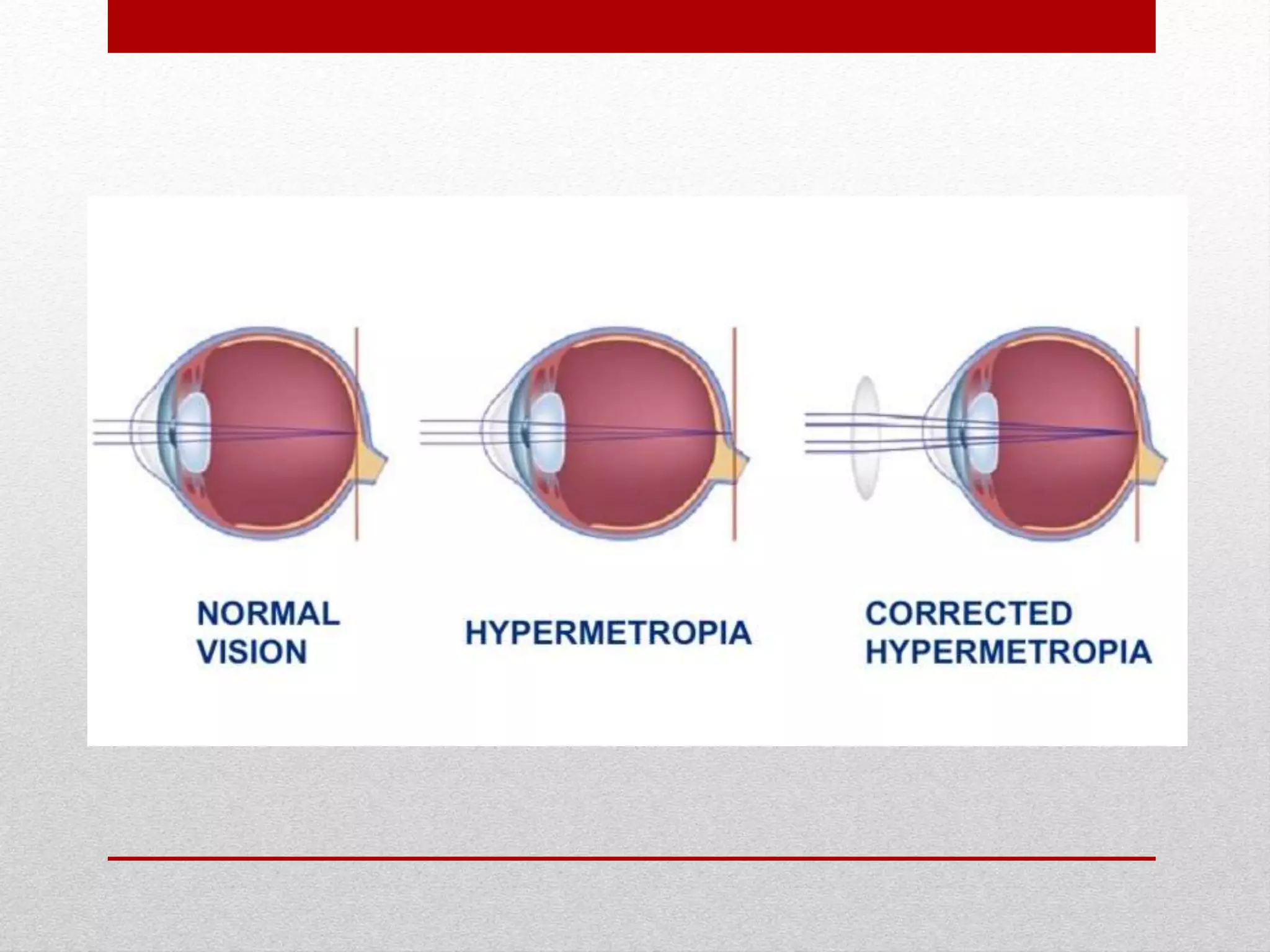 Hypermetropia | PPTX | Eye and Vision Conditions | Diseases and Conditions