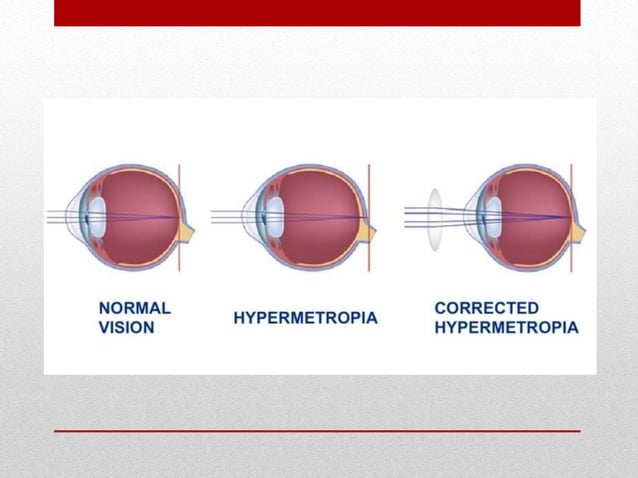 Hypermetropia | PPTX | Eye and Vision Conditions | Diseases and Conditions