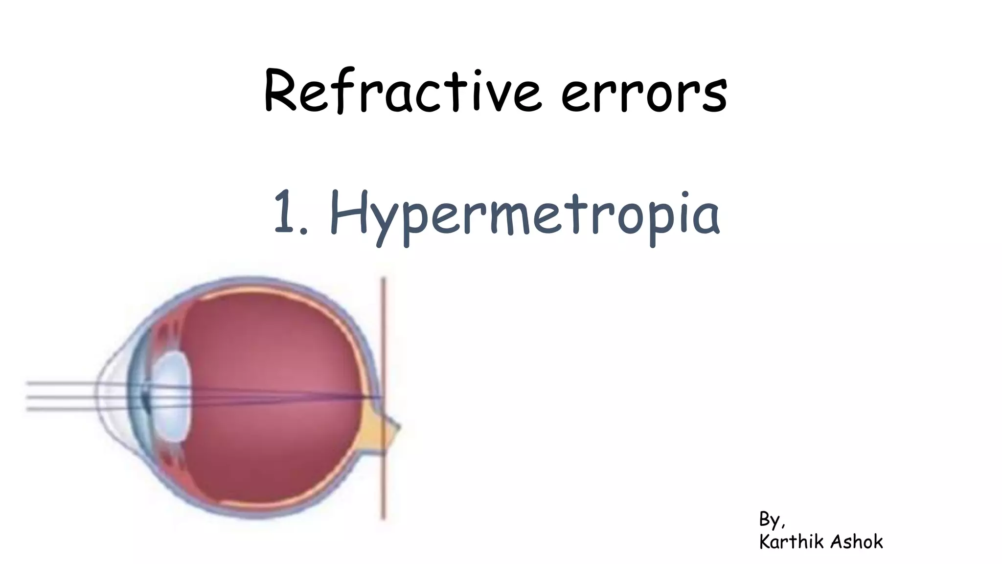 Hypermetropia | PPTX