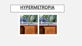 hypermetropia.pptx