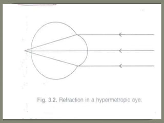 Hypermetropia.pptx