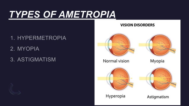 HYPERMETROPIA , basics of hypermetropia. | PPT