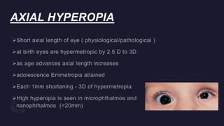 HYPERMETROPIA , basics of hypermetropia. | PPT
