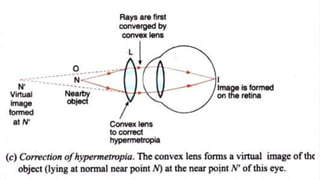 Hypermetropia - Intro, Causes, Types , Symptoms and Management | PPTX