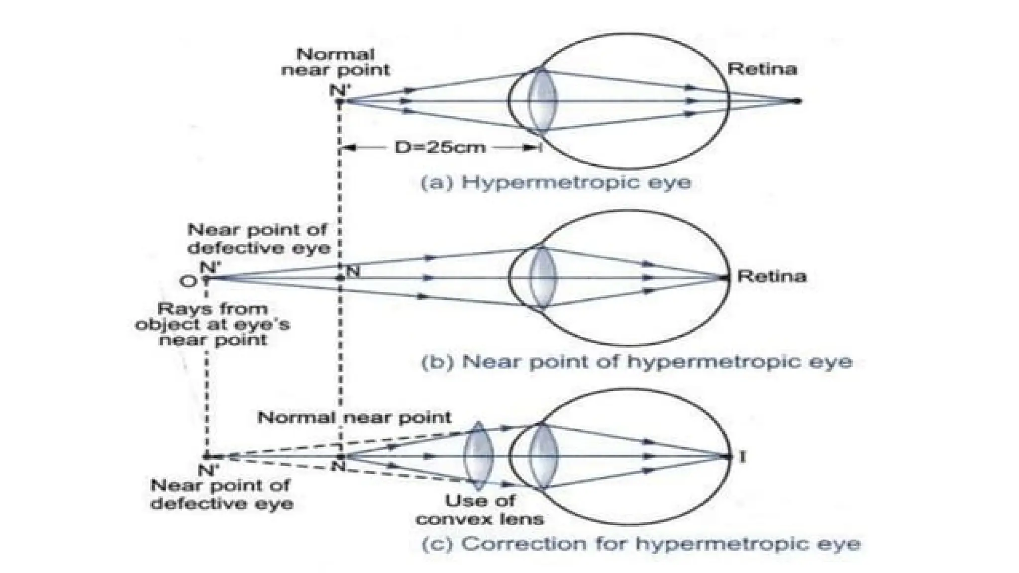 Hypermetropia - Eye ophthalmologyyy.pptx