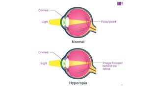Hypermetropia - Eye ophthalmologyyy.pptx