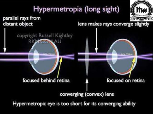 Hypermetropia | PPTX