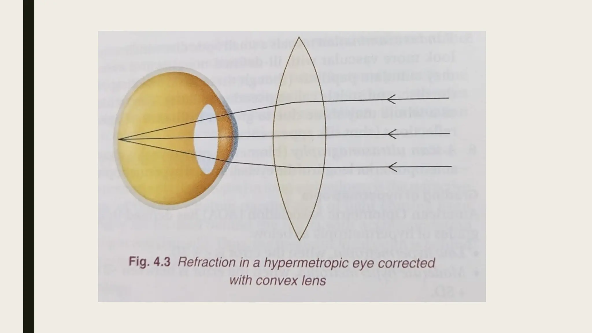 HYPERMETROPIA ophthalmology risk factors.pptx