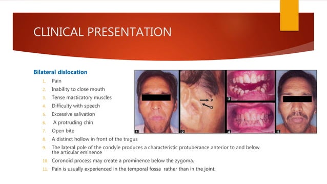 Hypermobility of TMJ | PPTX | Death, Injury, or Military Conflict ...
