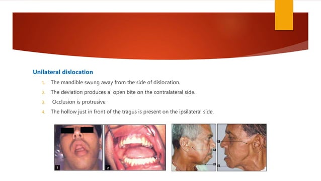 Hypermobility of TMJ | PPTX | Death, Injury, or Military Conflict ...