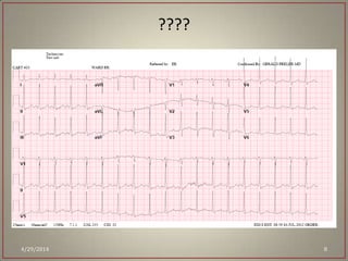 Hypernatremia Ecg