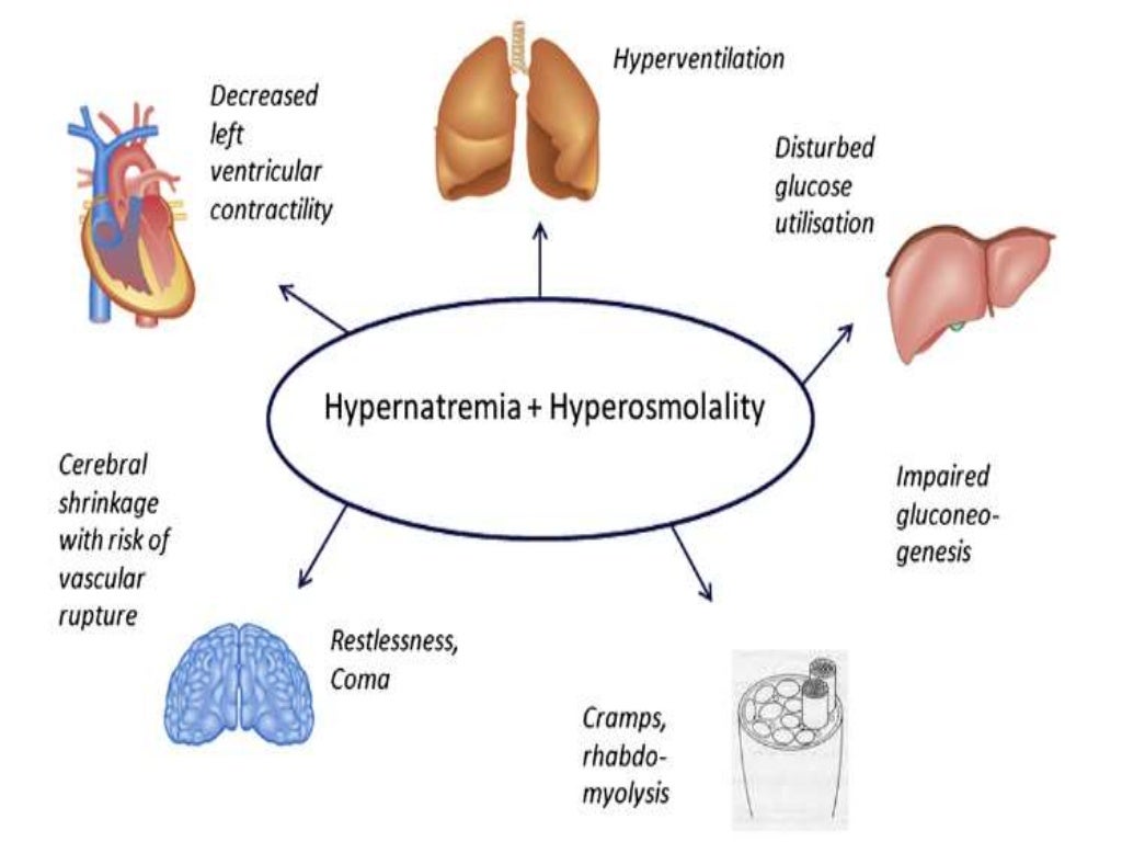 Hypernatremia