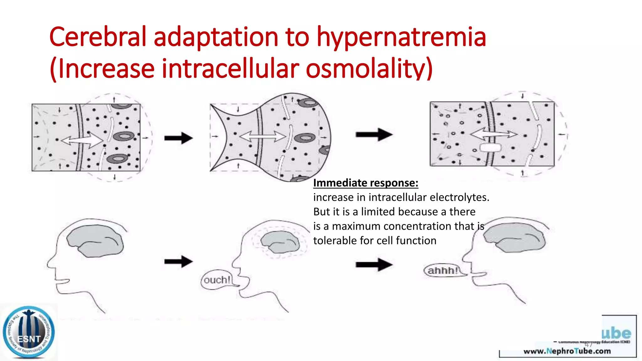 Hypernatremia - Stepwise Practical Approach - Dr. Gawad | PPTX