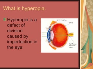 Hyperopia | PPT