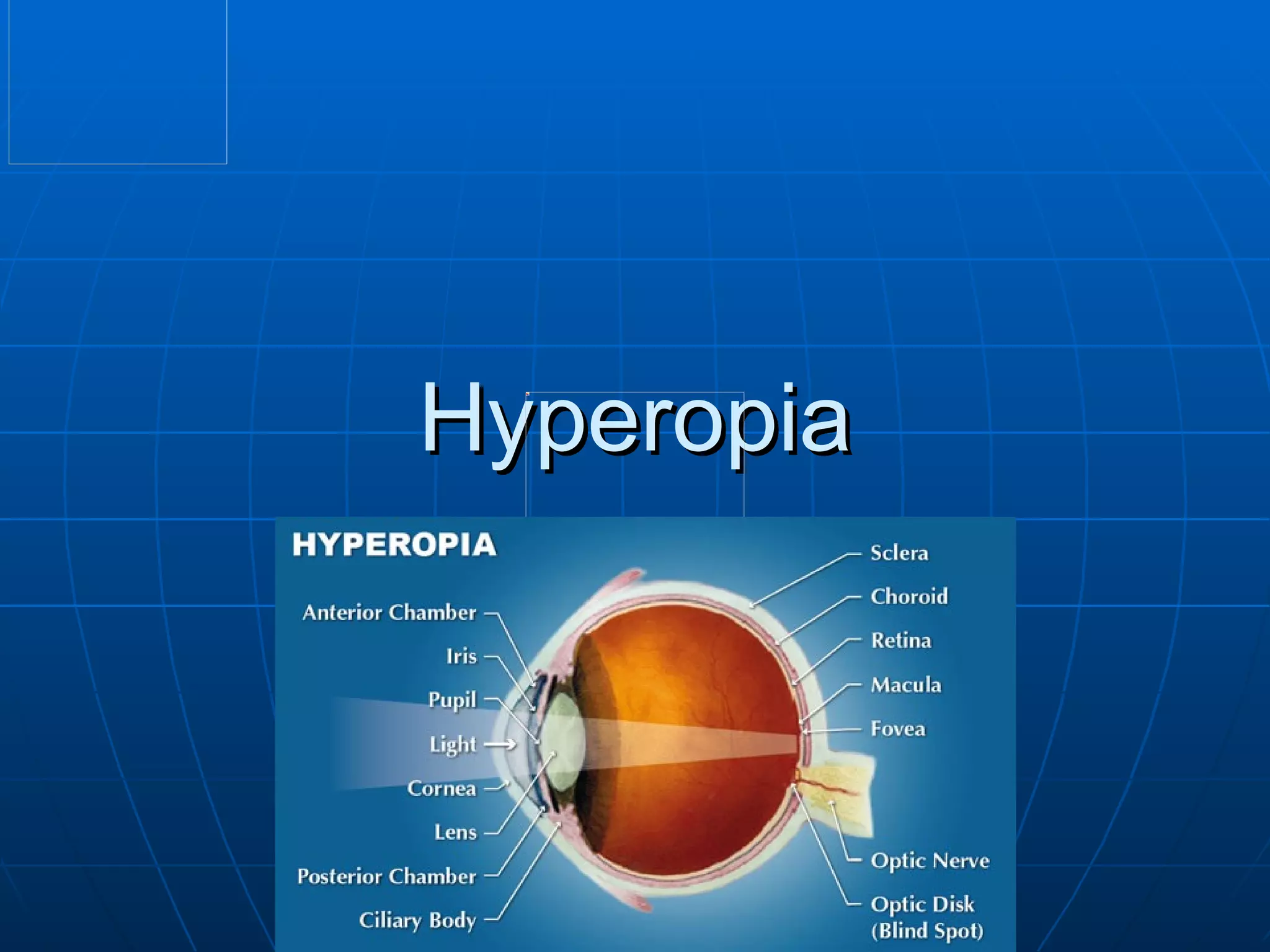 Hyperopia | PPT
