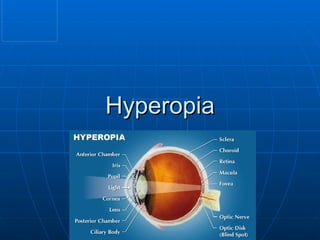 Hyperopia | PPT