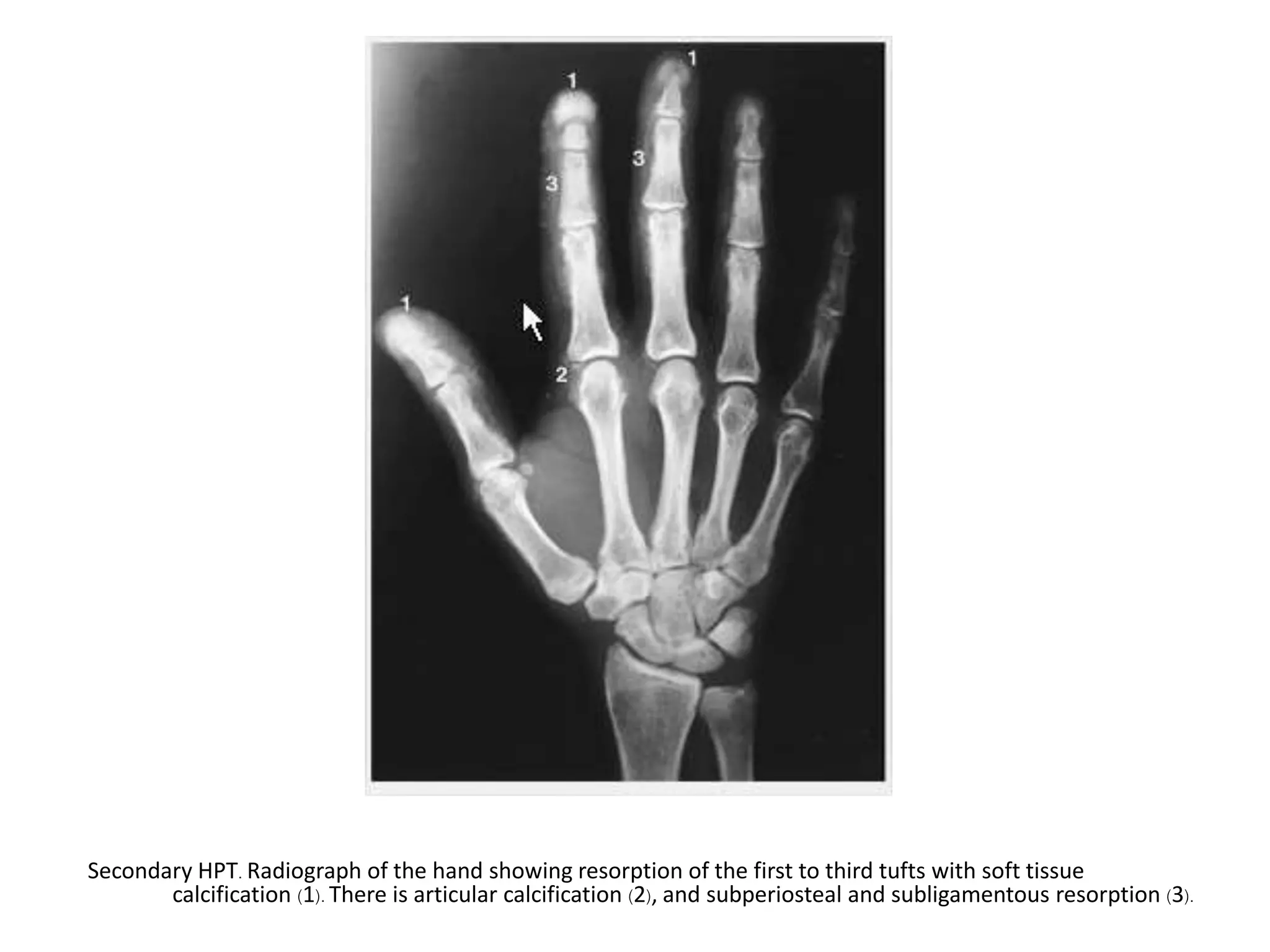 Hyperparathyroidism | PPTX
