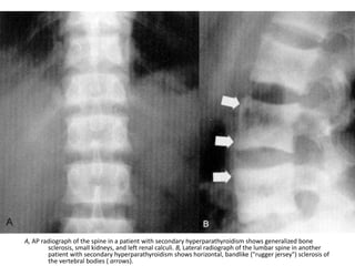 Hyperparathyroidism | PPTX