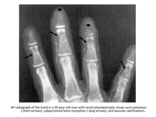 Hyperparathyroidism | PPTX