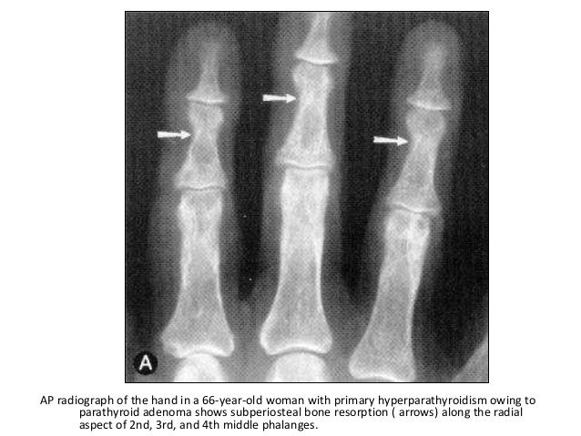 Primary Hyperparathyroidism Radiology