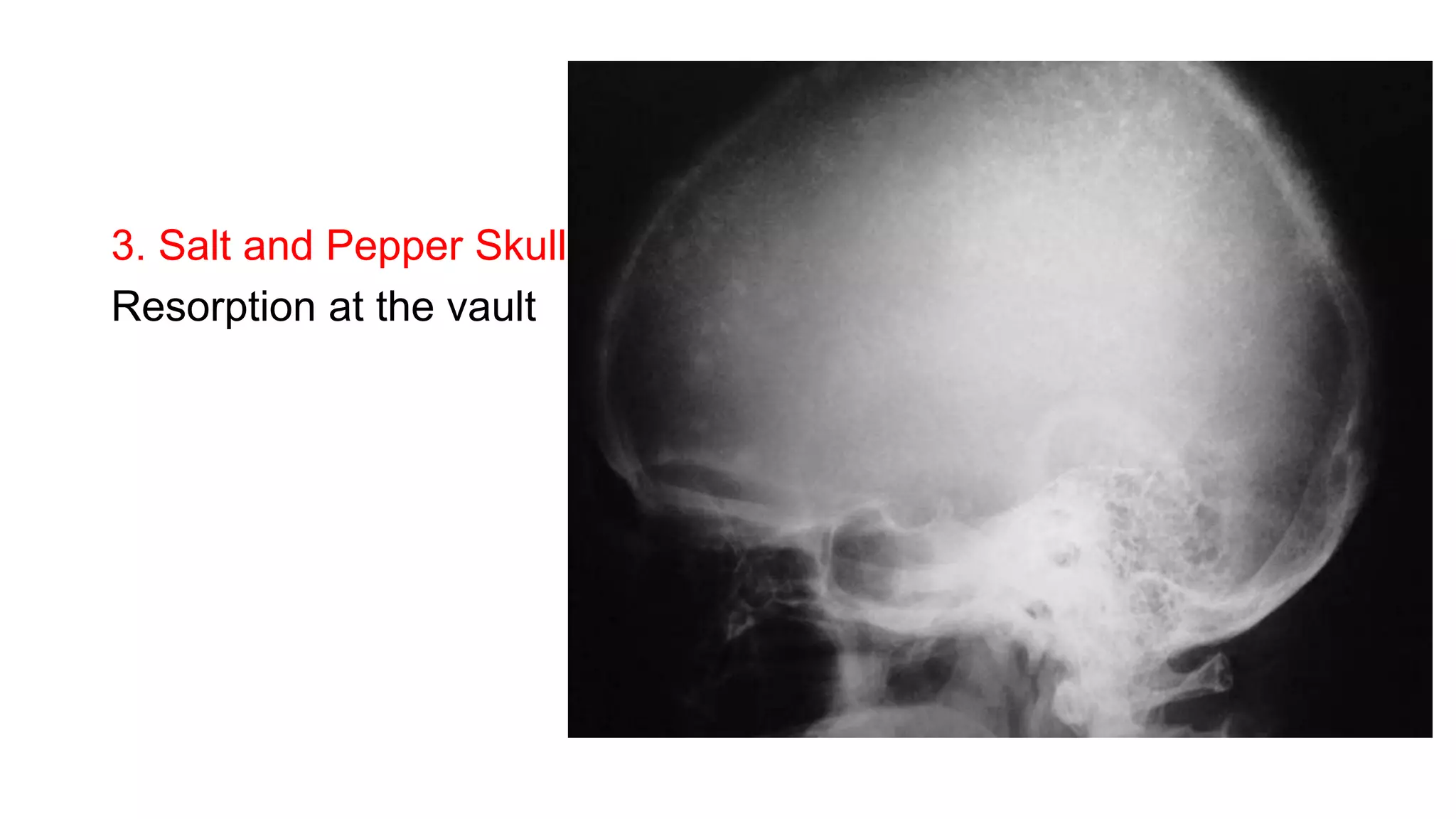 Hyperparathyroidism | PPTX