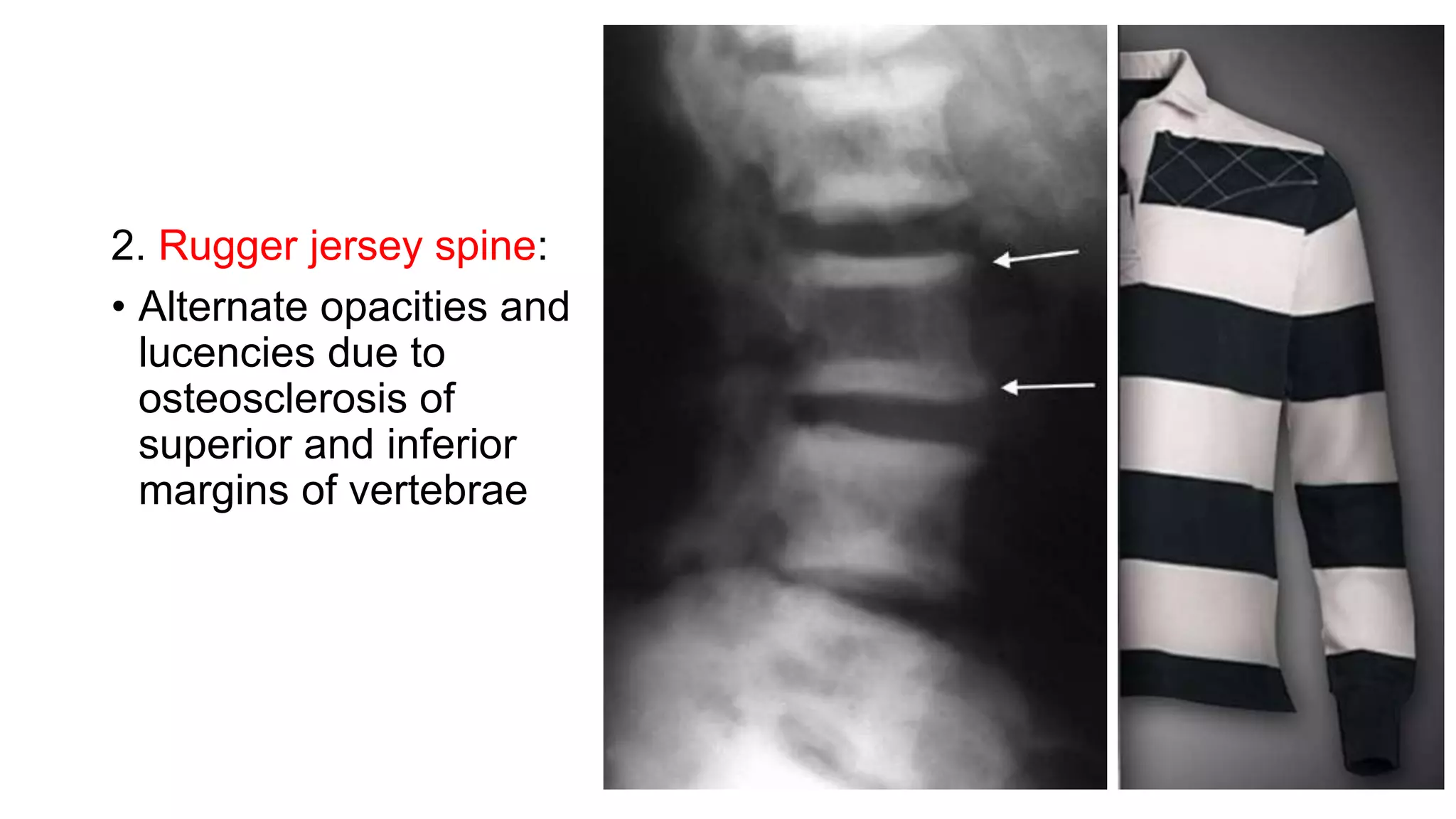 Hyperparathyroidism | PPTX