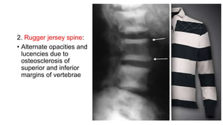 Hyperparathyroidism | PPTX