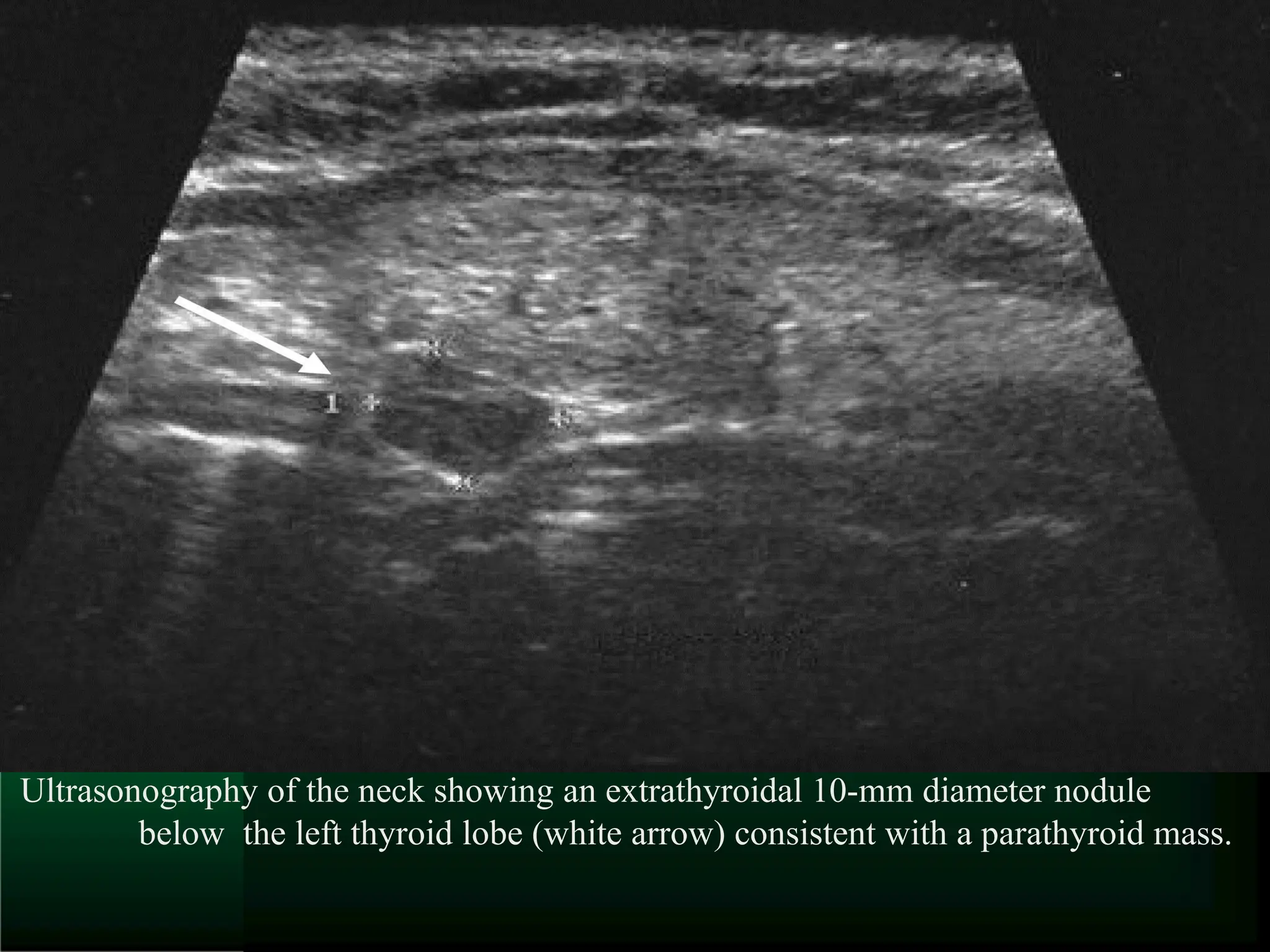 hyperparathyroidism types and management | PPTX