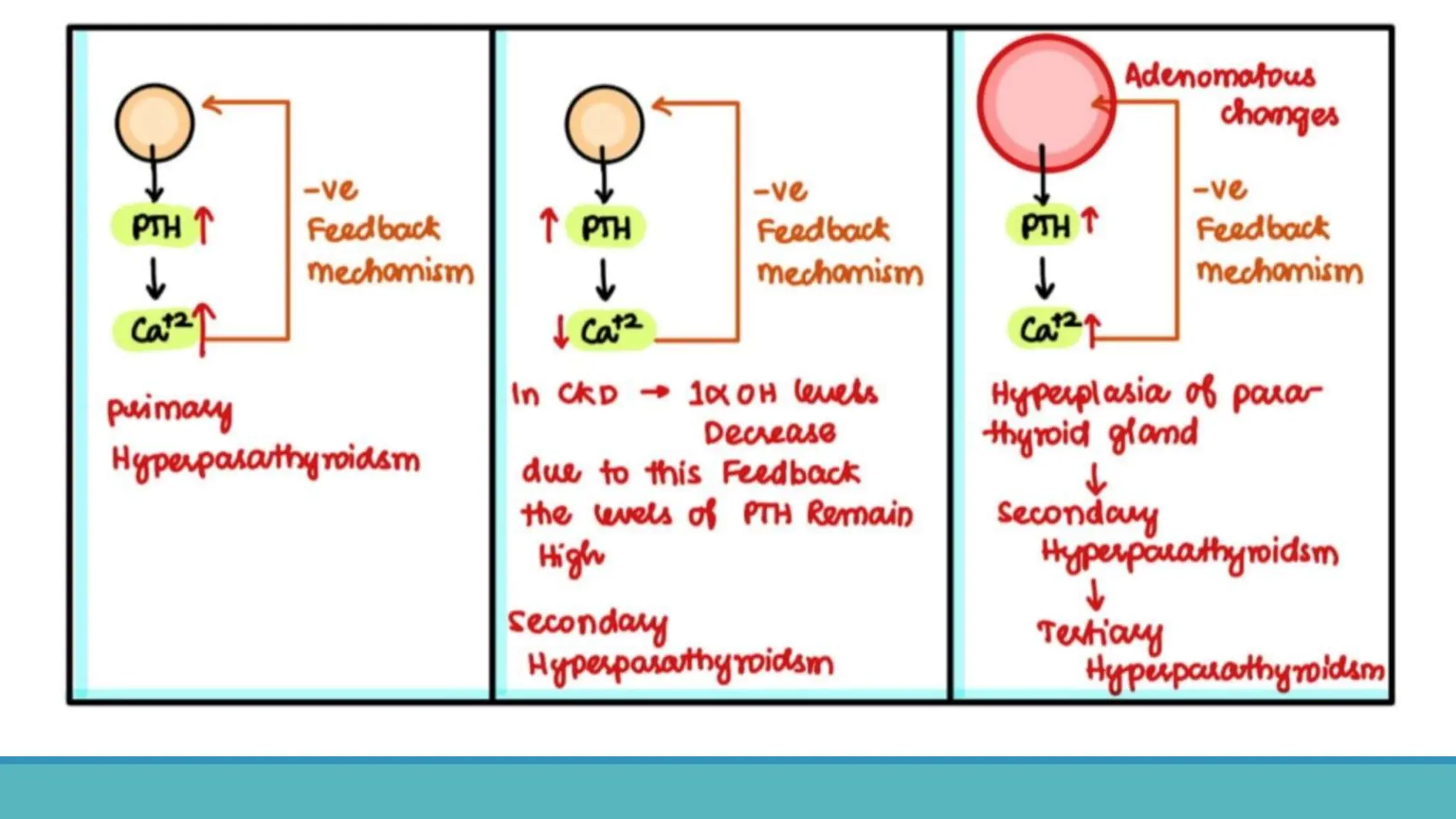 hyperparathyroidism imaging metabolic bone disease.pptx