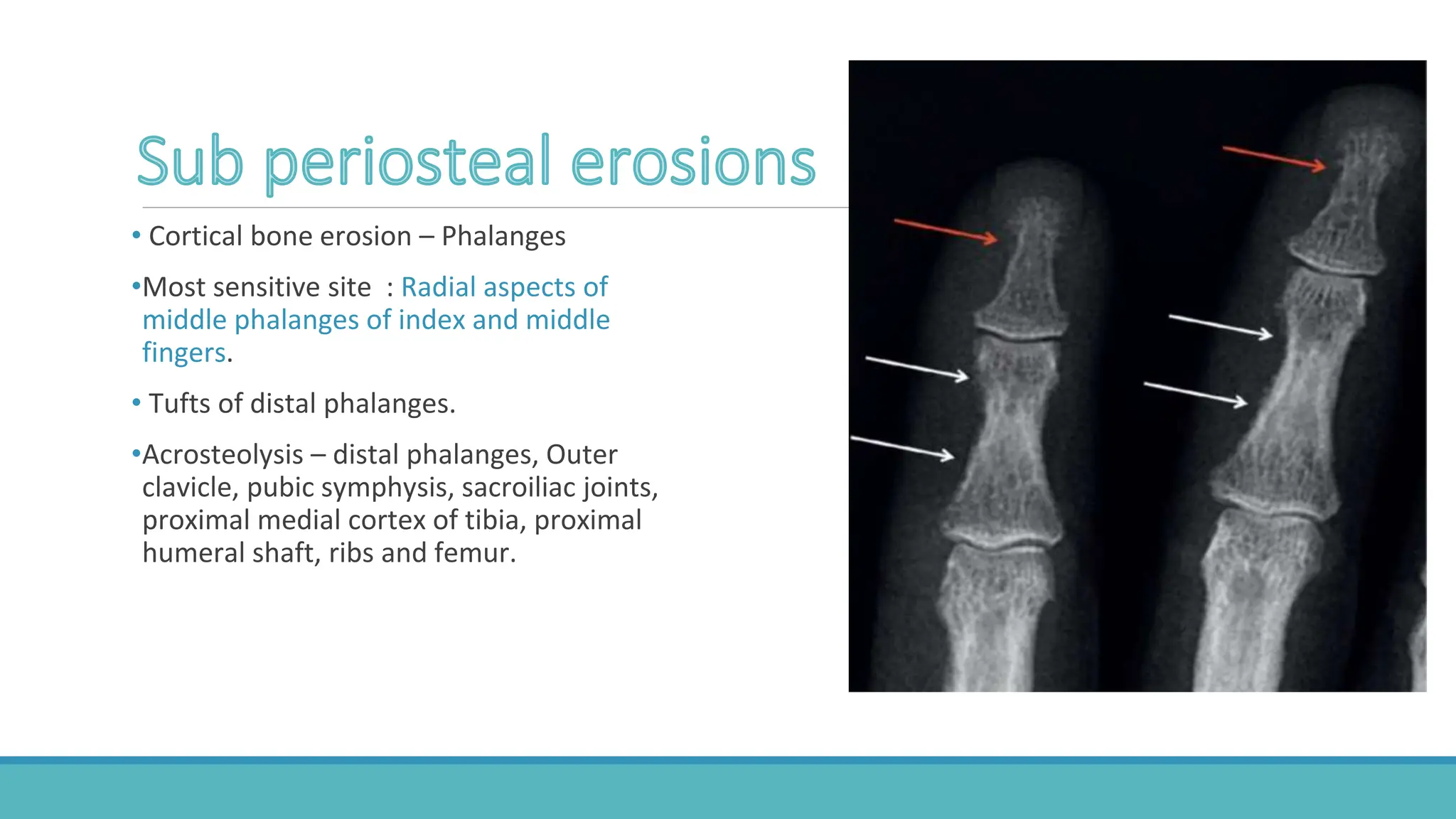 hyperparathyroidism imaging metabolic bone disease.pptx