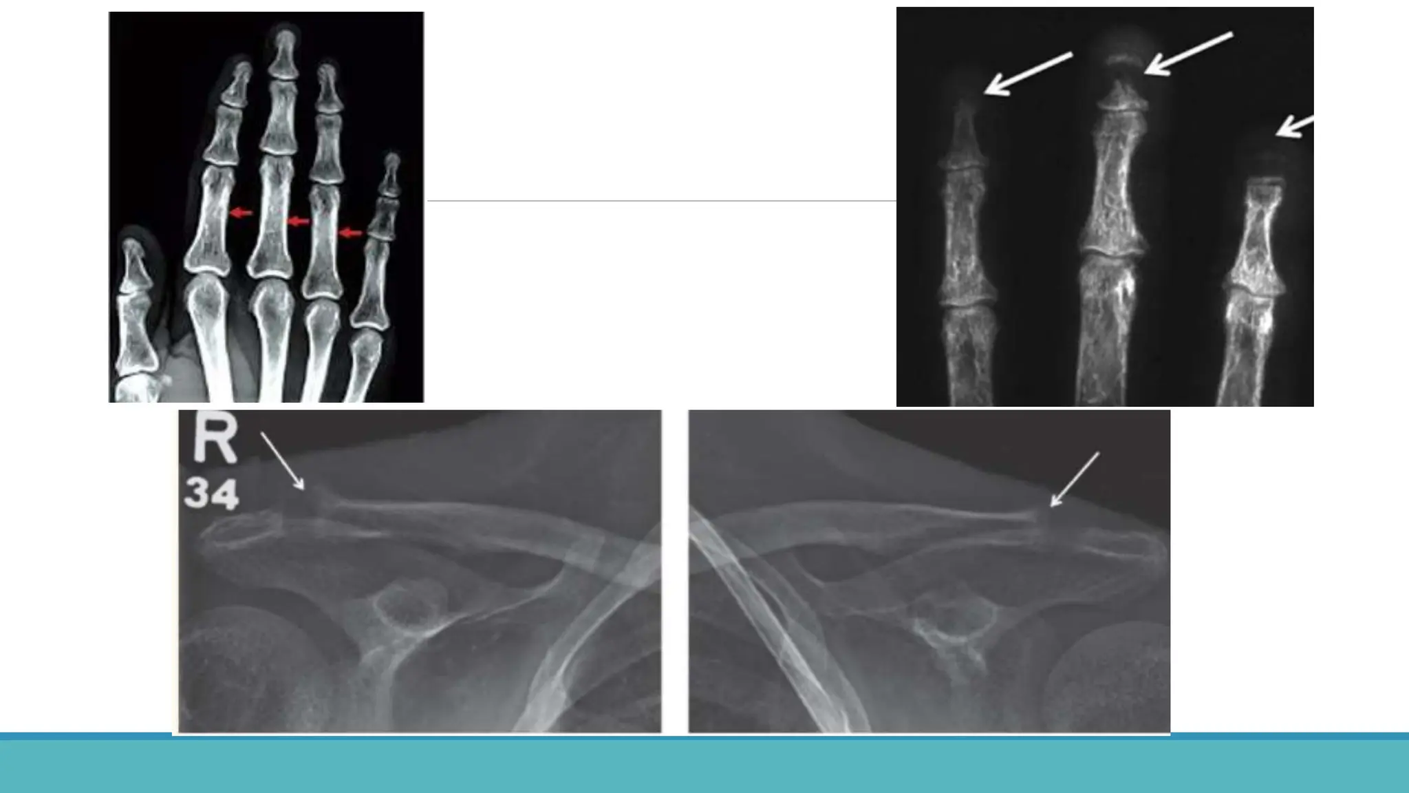 hyperparathyroidism imaging metabolic bone disease.pptx