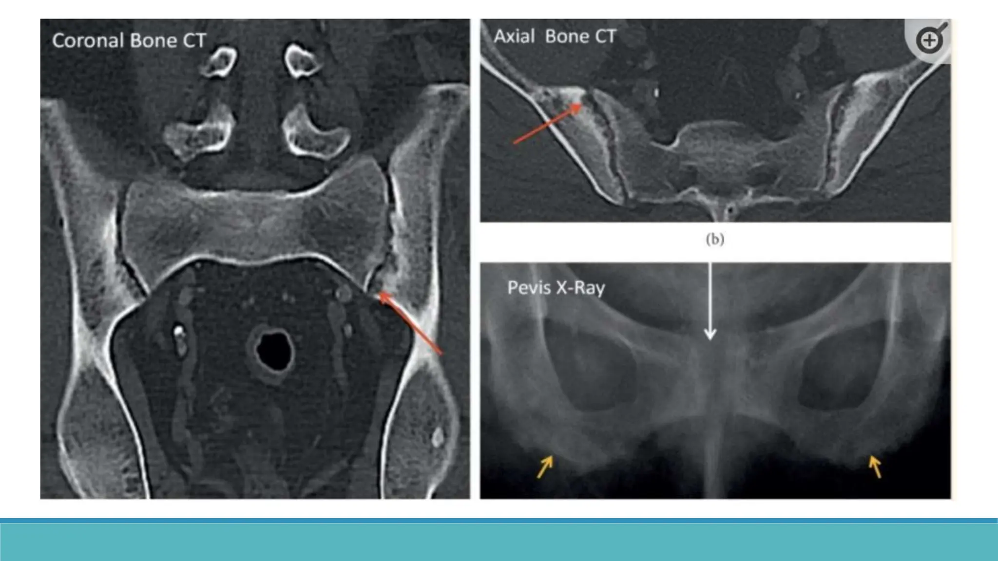 hyperparathyroidism imaging metabolic bone disease.pptx