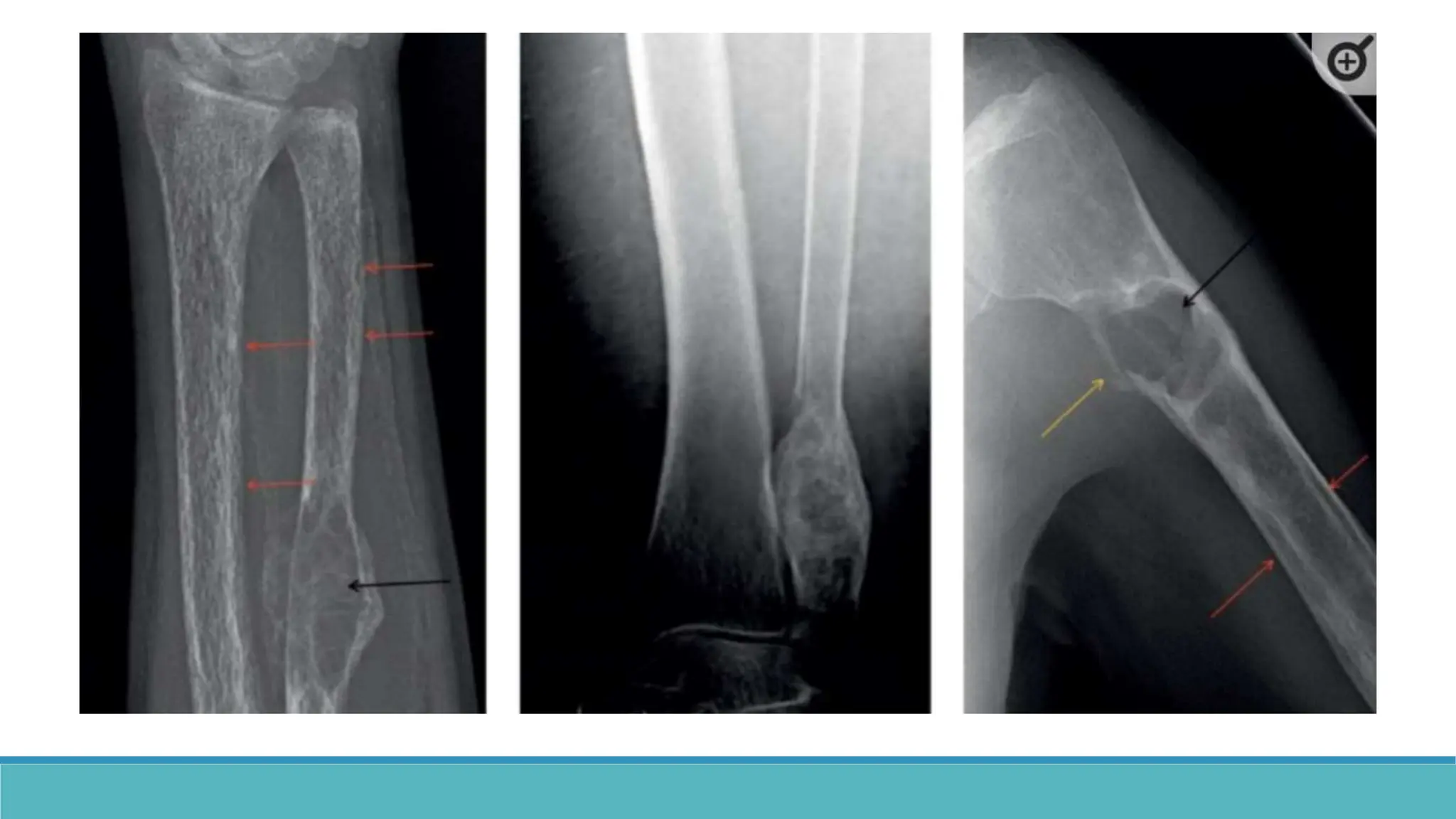hyperparathyroidism imaging metabolic bone disease.pptx