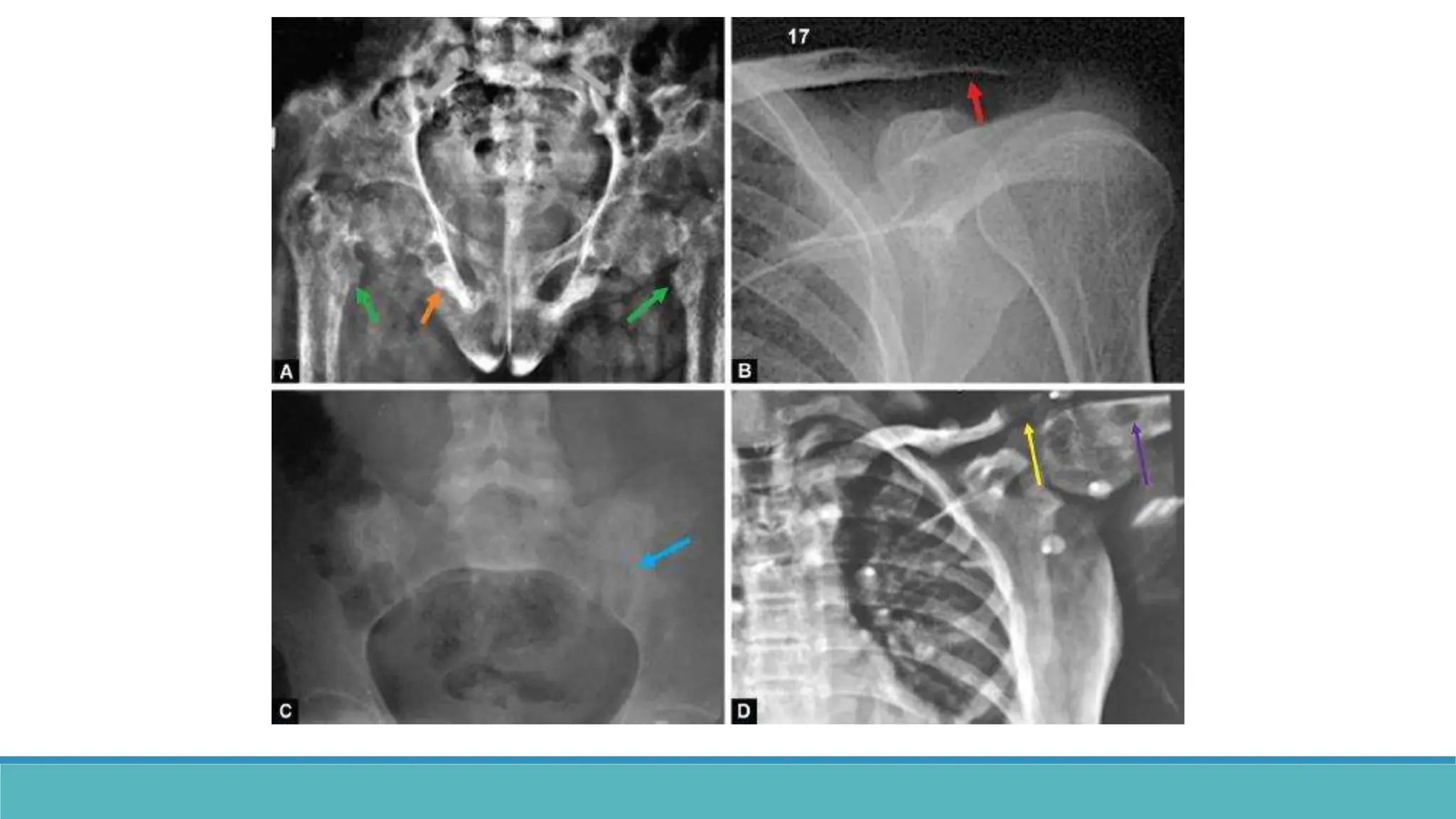hyperparathyroidism imaging metabolic bone disease.pptx