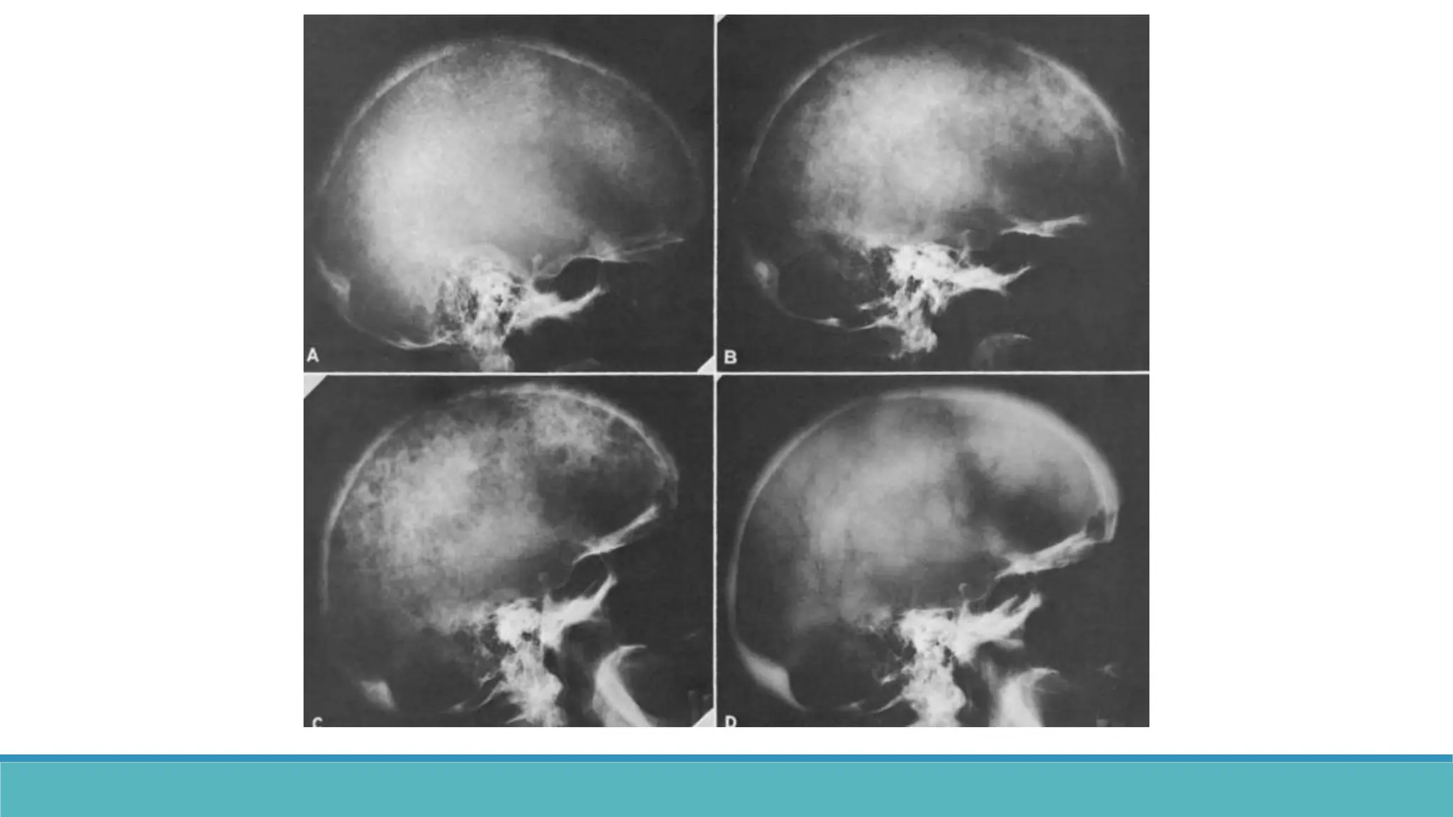 hyperparathyroidism imaging metabolic bone disease.pptx