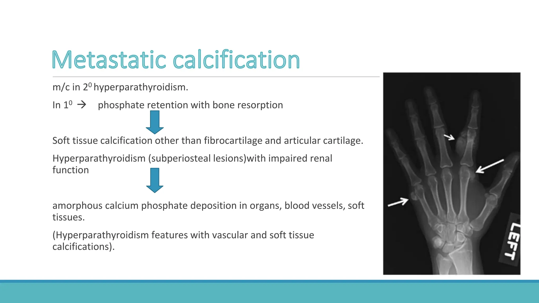 hyperparathyroidism imaging metabolic bone disease.pptx