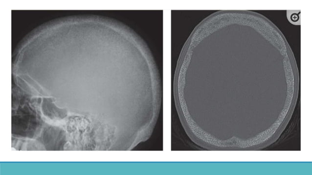 hyperparathyroidism imaging metabolic bone disease.pptx