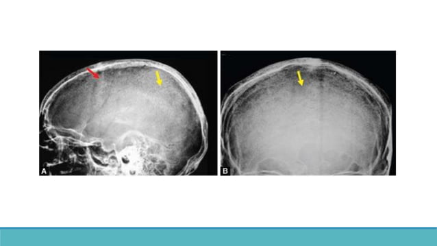 hyperparathyroidism imaging metabolic bone disease.pptx